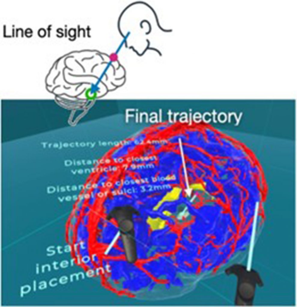 A Virtual-Reality System for Planning Deep Brain Stimulation Surgery ...