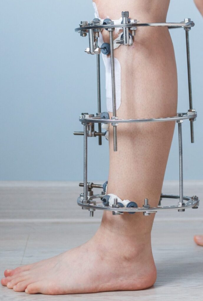 Internal Fixator Apparatus for Distraction Osteogenesis for Children ...